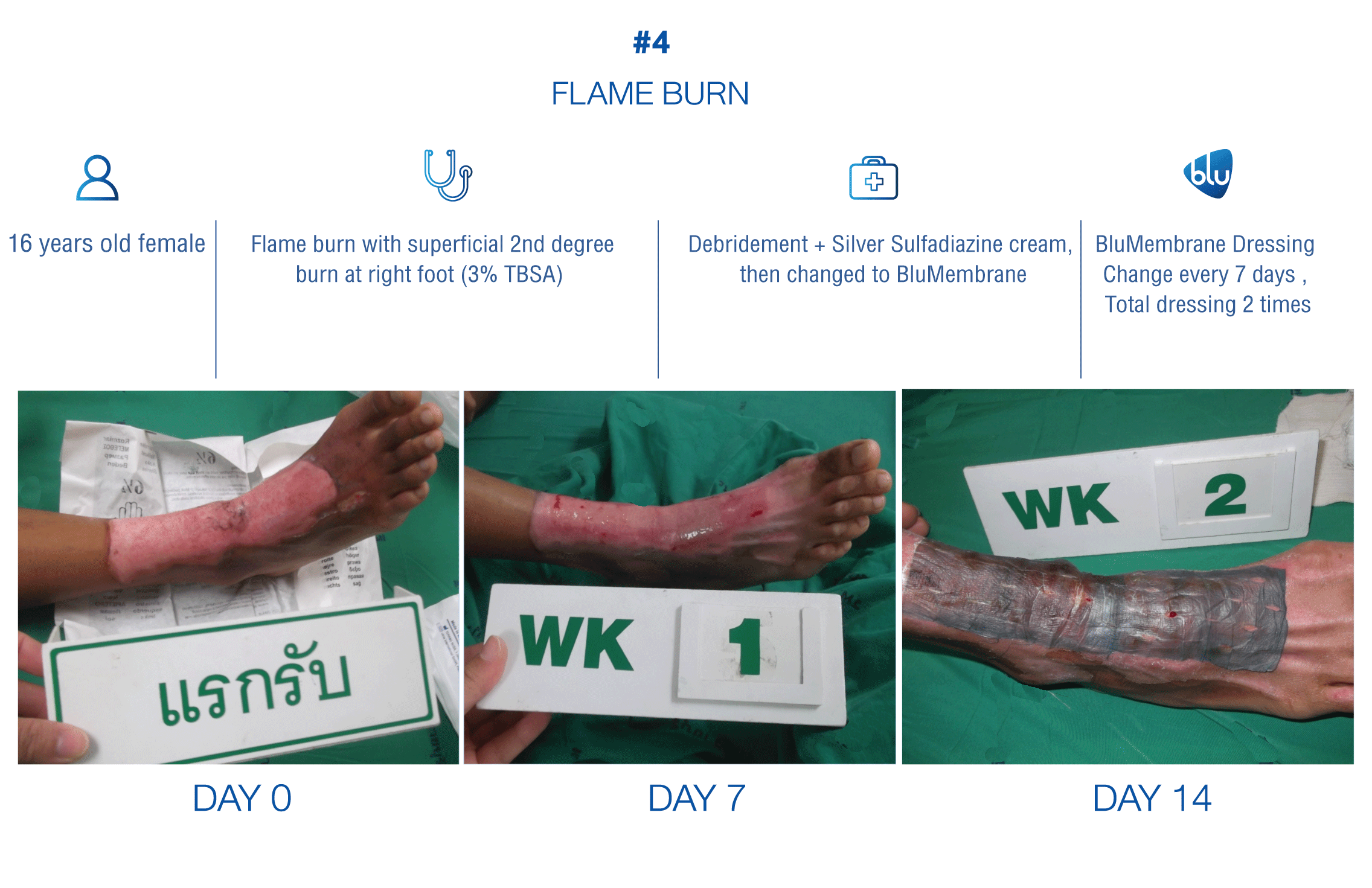 Burn Cases – Novatec Healthcare Co., Ltd.