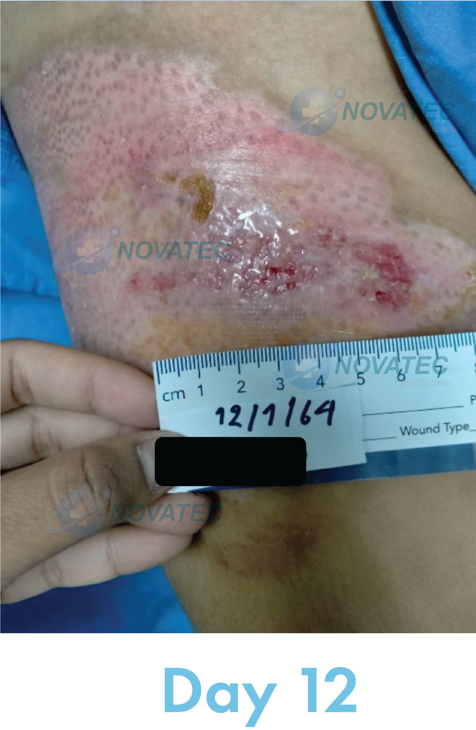 Scald Burn(6) – Novatec Healthcare Co., Ltd.